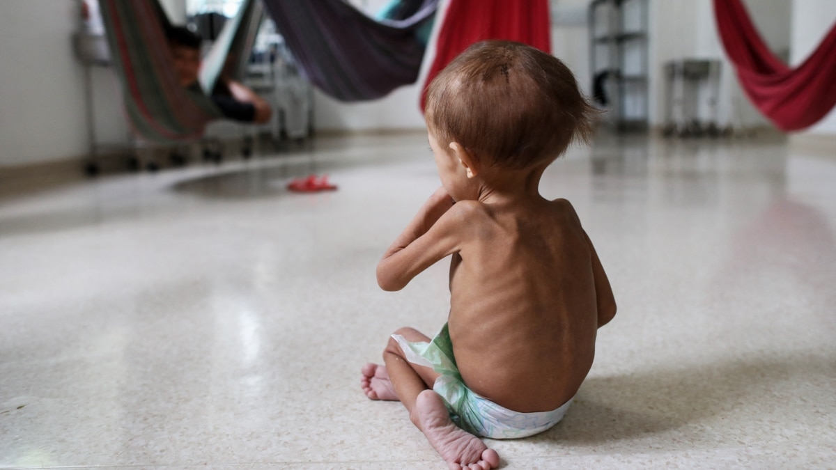 Desnutrición infantil: la catástrofe invisible