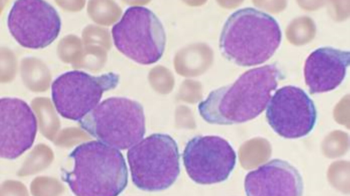 Terapi eksperimentale kundër leuçemisë