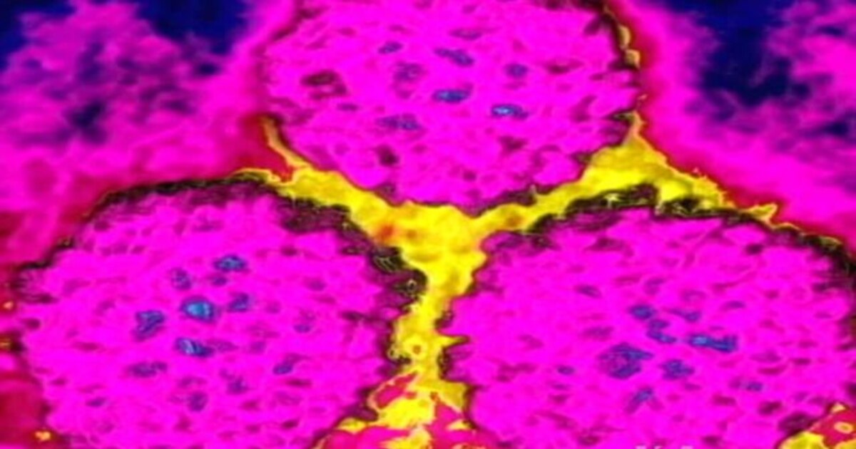 Oral Cancer Caused by HPV Soars in Developed Countries