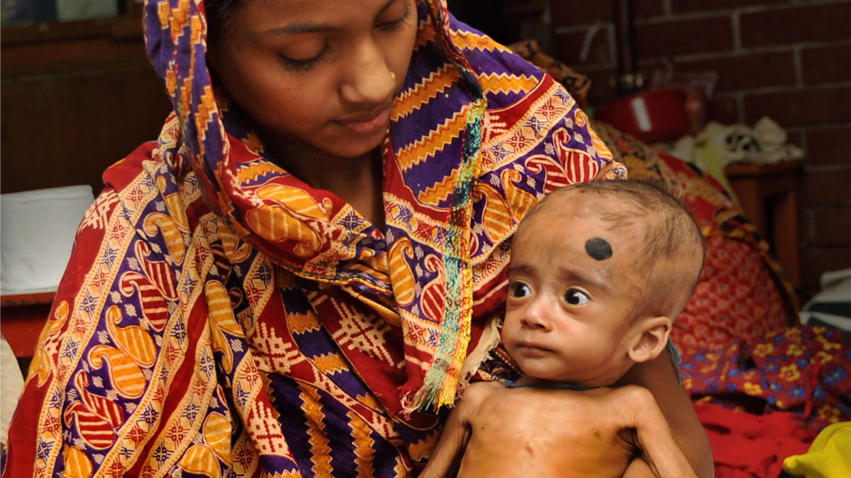 Study: Malnutrition Damages Gut Microbes, Stunting Children's Growth ...