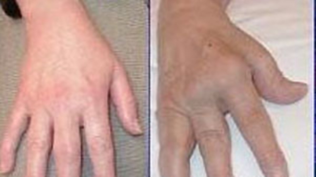 Trajtimi i artritit reumatik