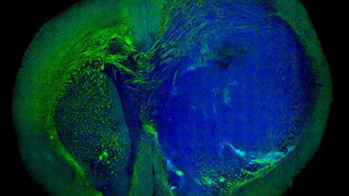Scientists Use Polio Virus to Fight Brain Tumors