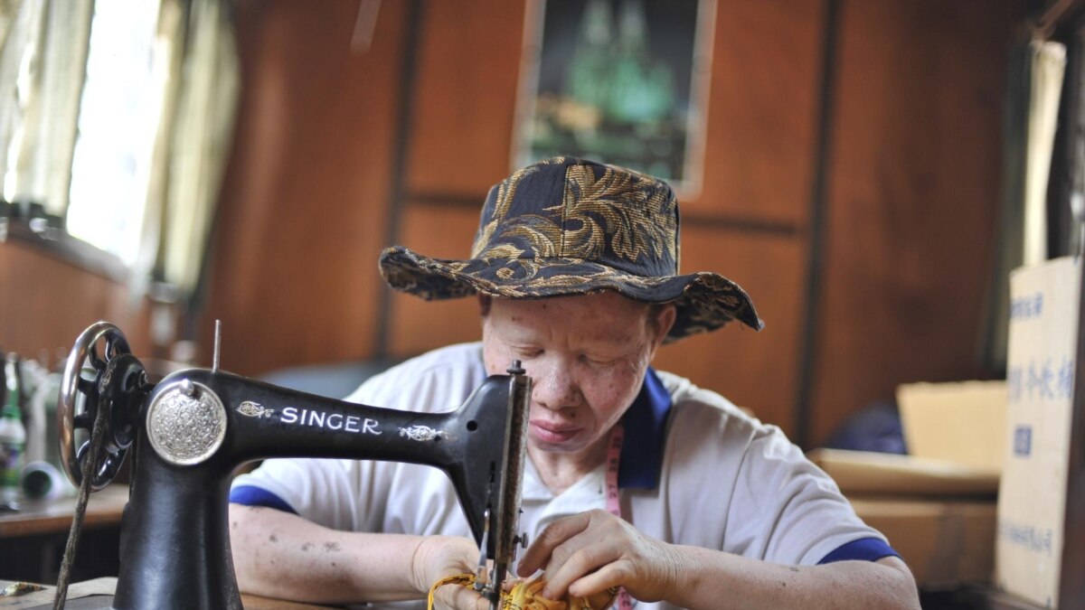Kwezempilakahle: Inhlupho Ezihlangana Labaphila leAlbinism