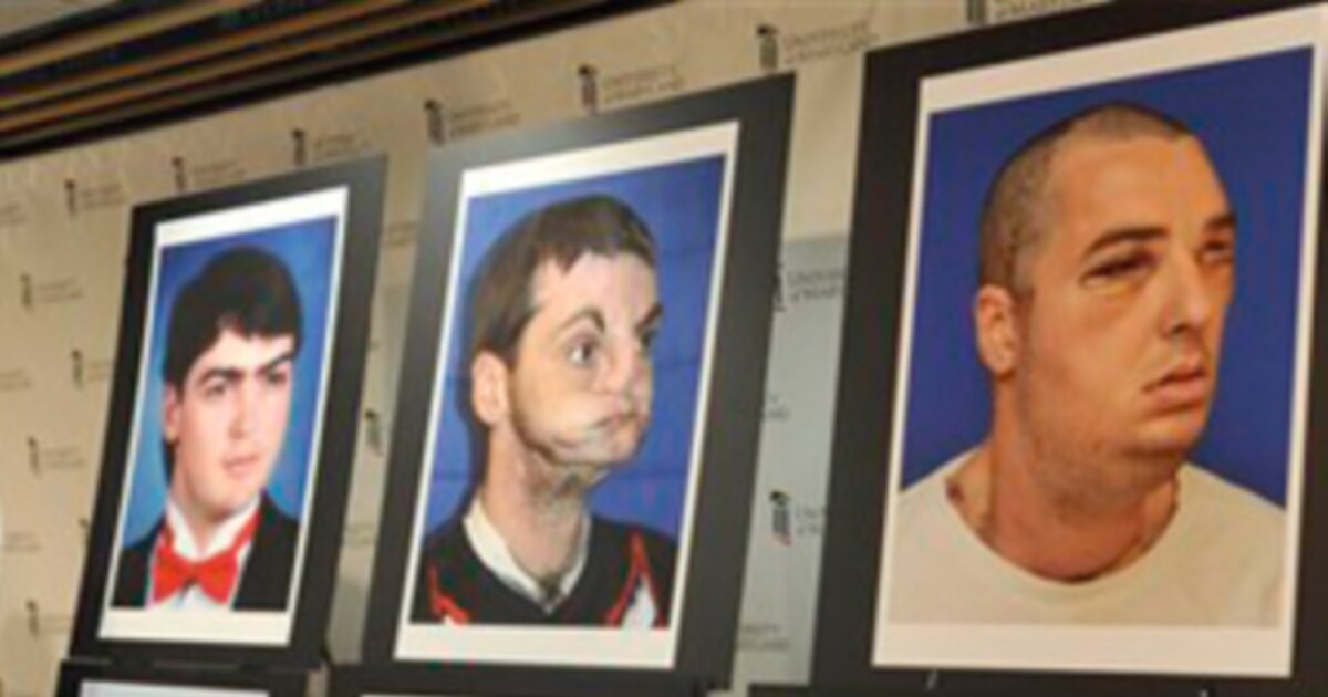 Doctors Call World's First Full Face Transplant A Resounding Success