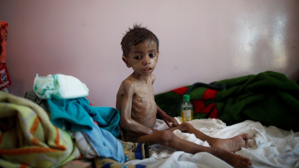 UN Agency: Child Malnutrition at 'All-time High' in Yemen