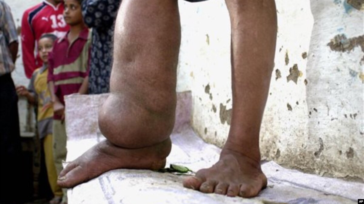 Can Treated Mosquito Net Stop Elephantiasis