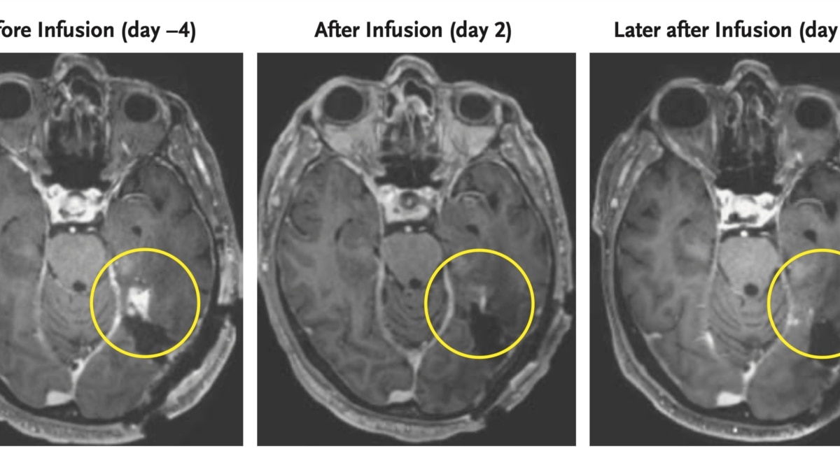 New Way to Fight Brain Cancer Shows Promise