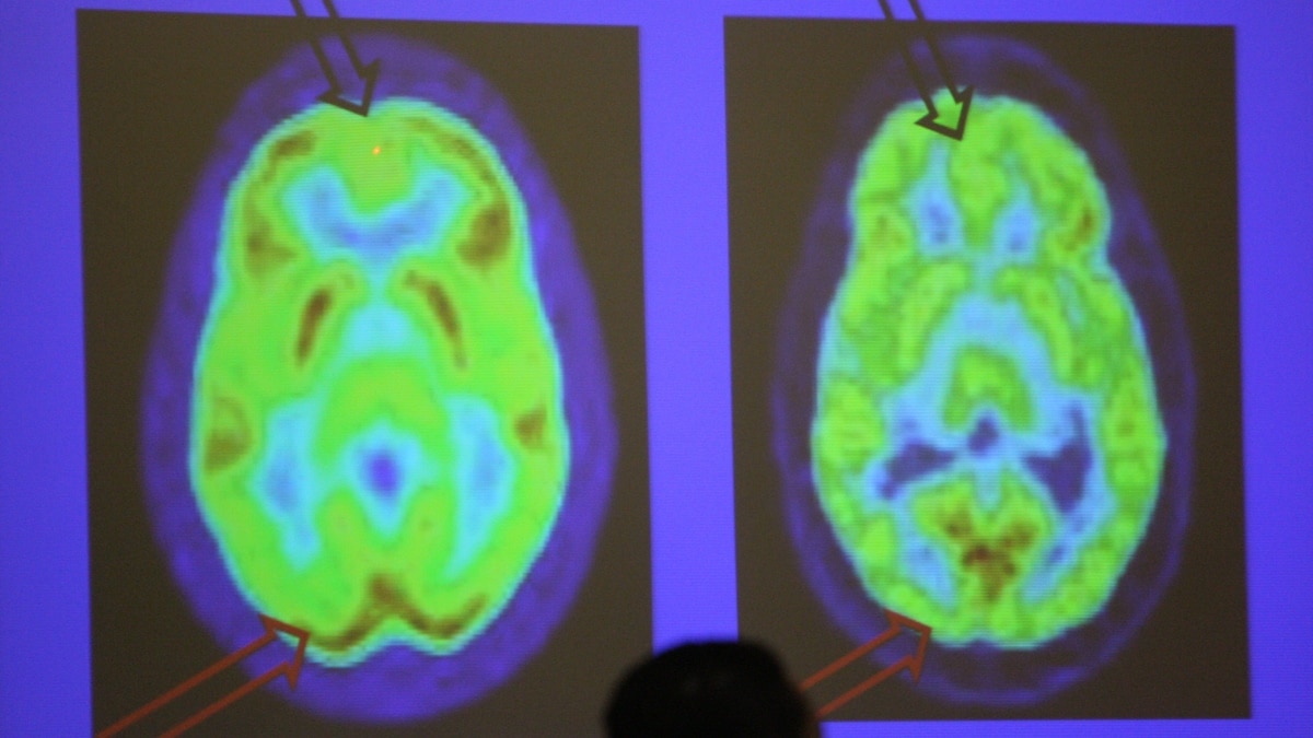 Researchers Repair Brain Injuries With New Cells