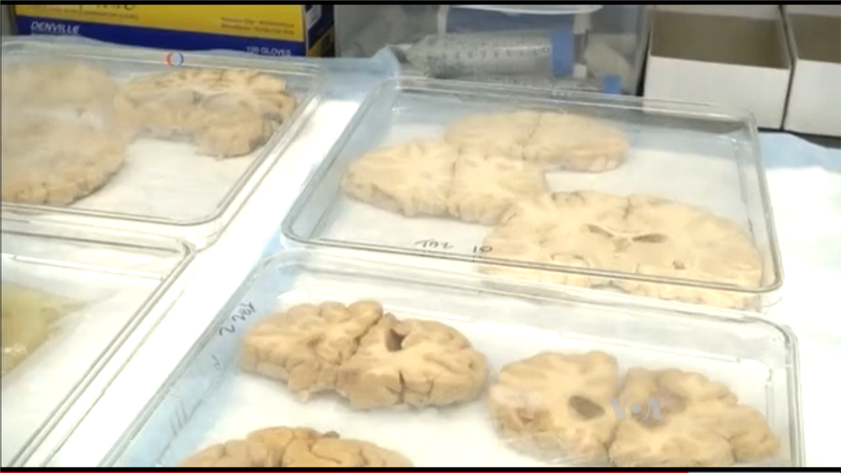 Explosions Change Soldiers’ Brains, Study Says