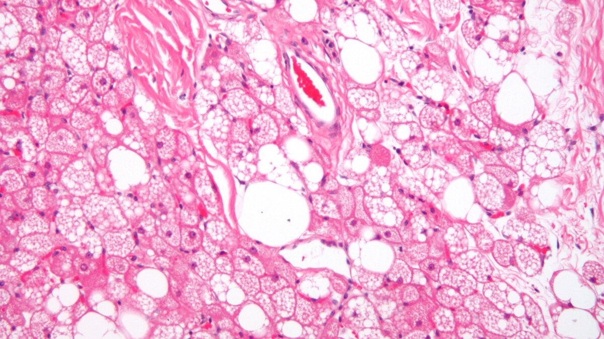 Study: Fat Cells Protect Against Infections