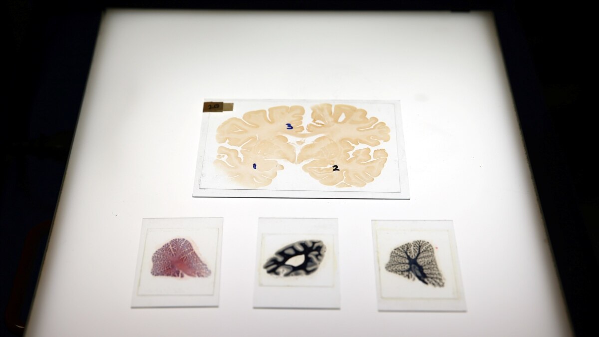 Australian Researchers Hope Brain Gel Can Reverse Parkinson’s Disease ...