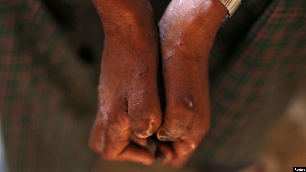 Leprosy Resurfacing in Malawi