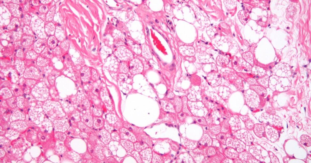 Study: Fat Cells Protect Against Infections