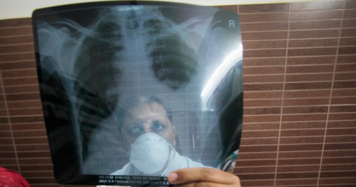 Rise of Superbug Tuberculosis Hampers Global Control Efforts
