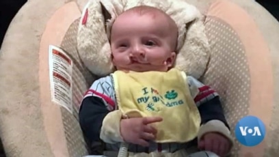 Girl Born Without Lips Or Chin | Lipstutorial.org